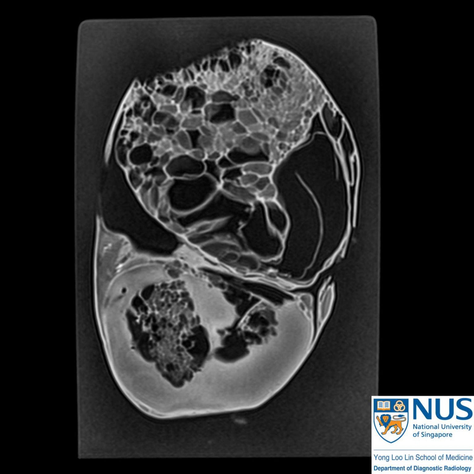 Systemic Pathology: Female Genital Tract – NUS Pathweb :: NUS Pathweb