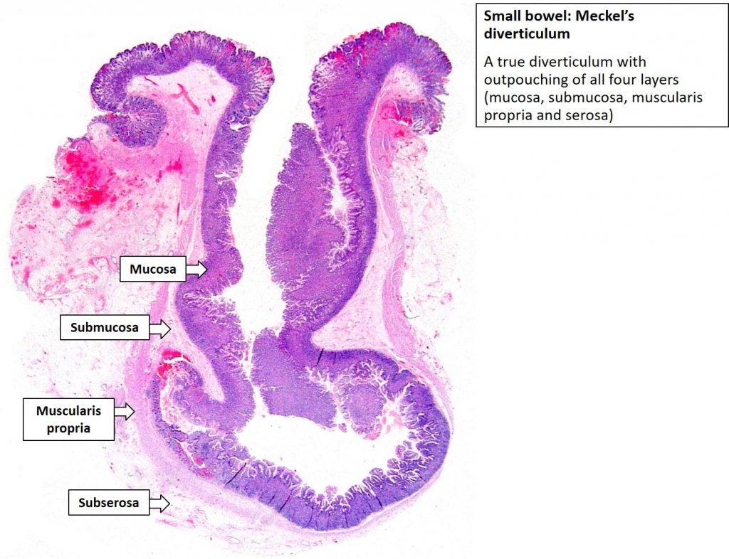 Ileum – Meckel’s diverticulum – NUS Pathweb :: NUS Pathweb