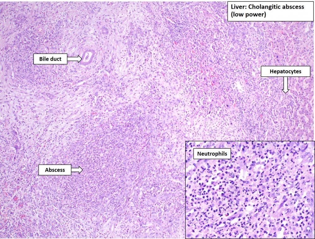 Liver – Cholangitic Abscess – NUS Pathweb :: NUS Pathweb