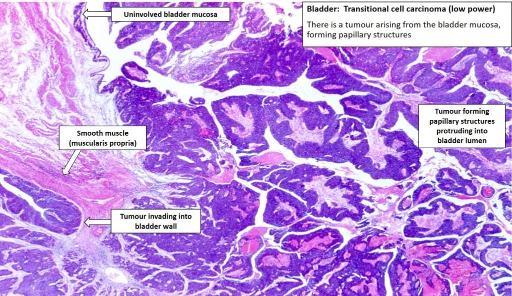 Bladder – Urothelial carcinoma (transitional cell carcinoma) – NUS ...