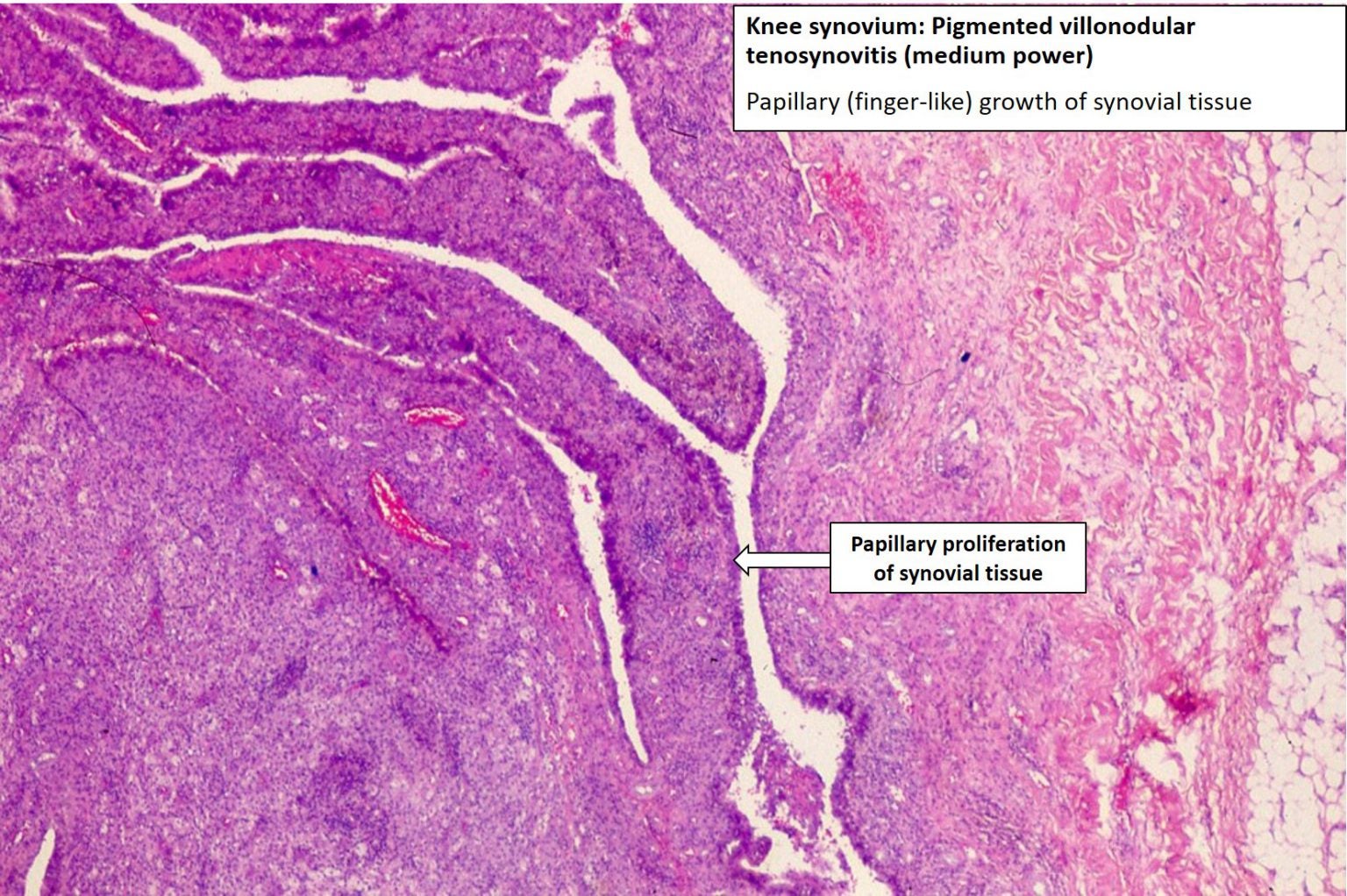 Knee – Villonodular synovitis (knee)/Tenosynovial giant cell tumour ...