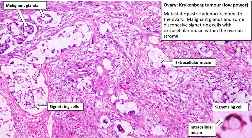 Ovaries – Krukenberg tumour – NUS Pathweb :: NUS Pathweb
