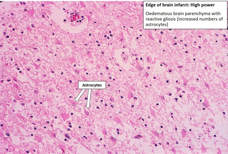 Brain – Infarct – NUS Pathweb :: NUS Pathweb