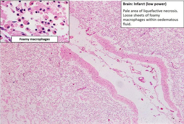 Brain – Infarct – NUS Pathweb :: NUS Pathweb
