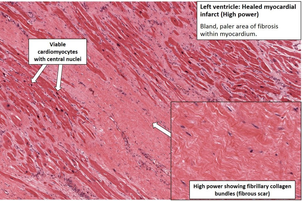 Heart – Infarct – NUS Pathweb :: NUS Pathweb