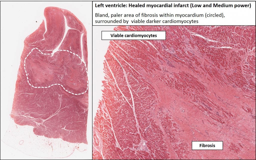 Heart – Infarct – NUS Pathweb :: NUS Pathweb