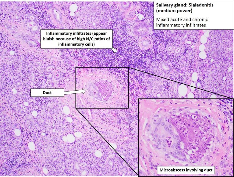 Salivary Gland – Sialolithiasis with Sialandenitis – NUS Pathweb :: NUS ...
