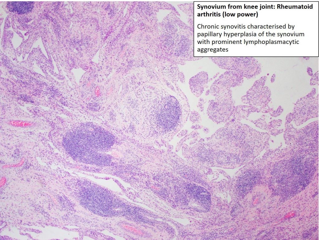 Tibia – Rheumatoid Arthritis – NUS Pathweb :: NUS Pathweb
