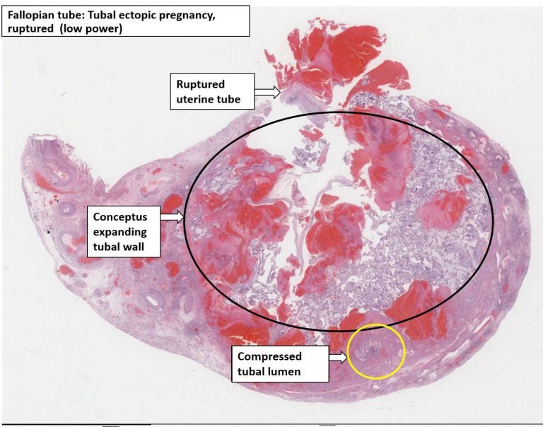 Fallopian Tube – Tubal Ectopic Pregnancy – NUS Pathweb :: NUS Pathweb