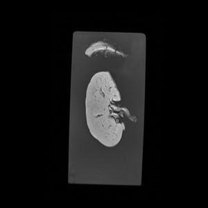 Kidney Infarct Nus Pathology
