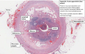 Appendix – Acute Appendicitis – NUS Pathweb :: NUS Pathweb