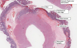 Stomach – Chronic Peptic Ulcer – NUS Pathweb :: NUS Pathweb