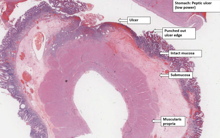 Stomach – Chronic peptic ulcer – NUS Pathweb :: NUS Pathweb