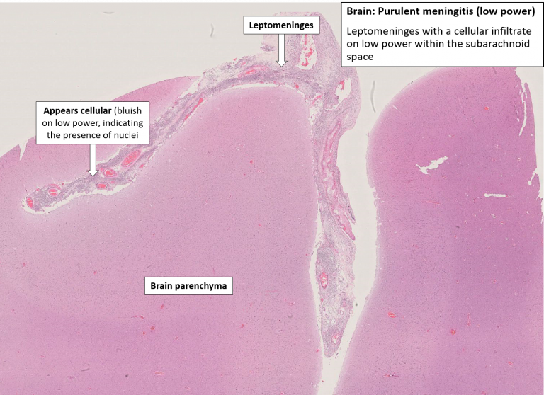 Brain – Purulent Meningitis – NUS Pathweb :: NUS Pathweb