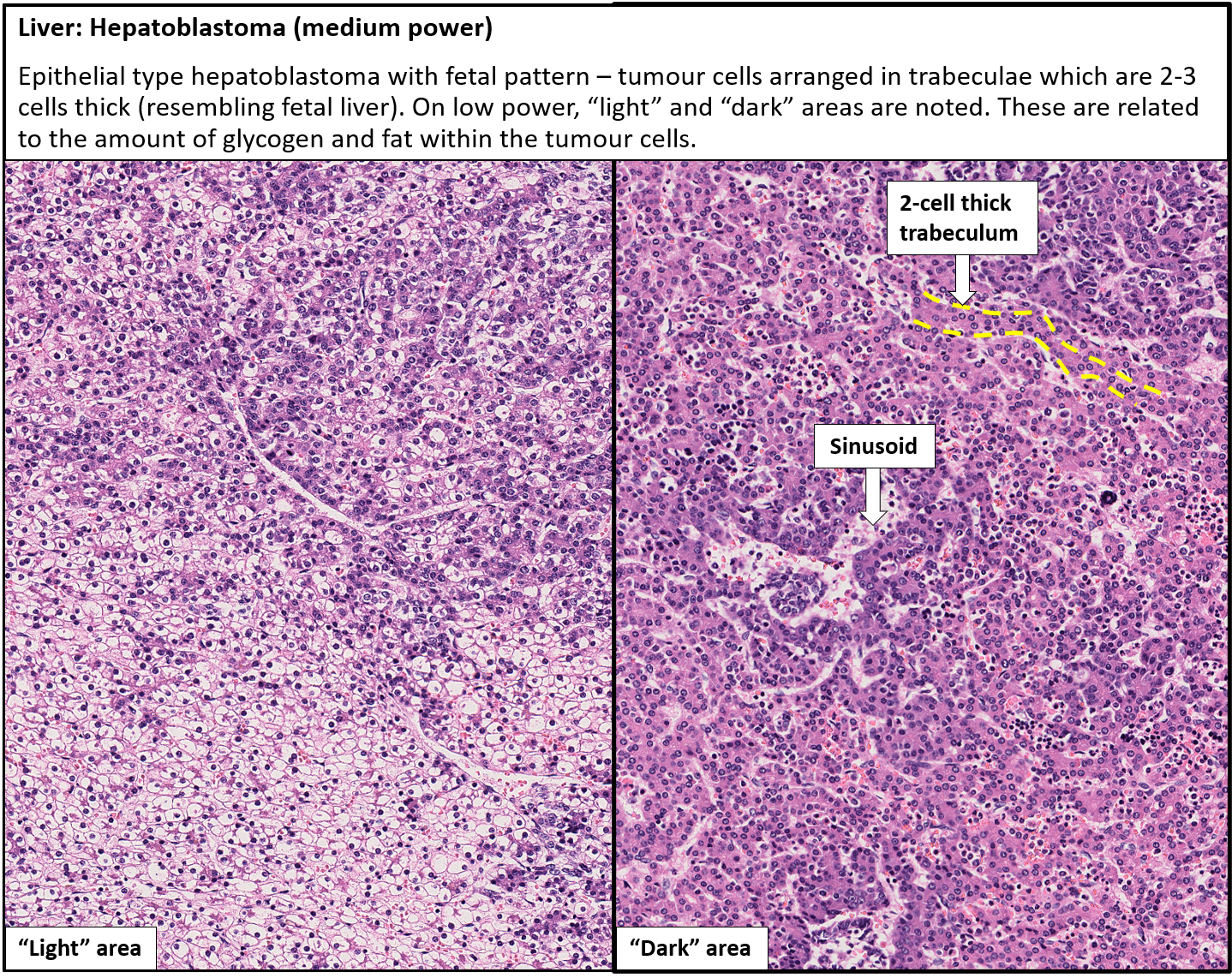 Liver – Hepatoblastoma – NUS Pathweb :: NUS Pathweb