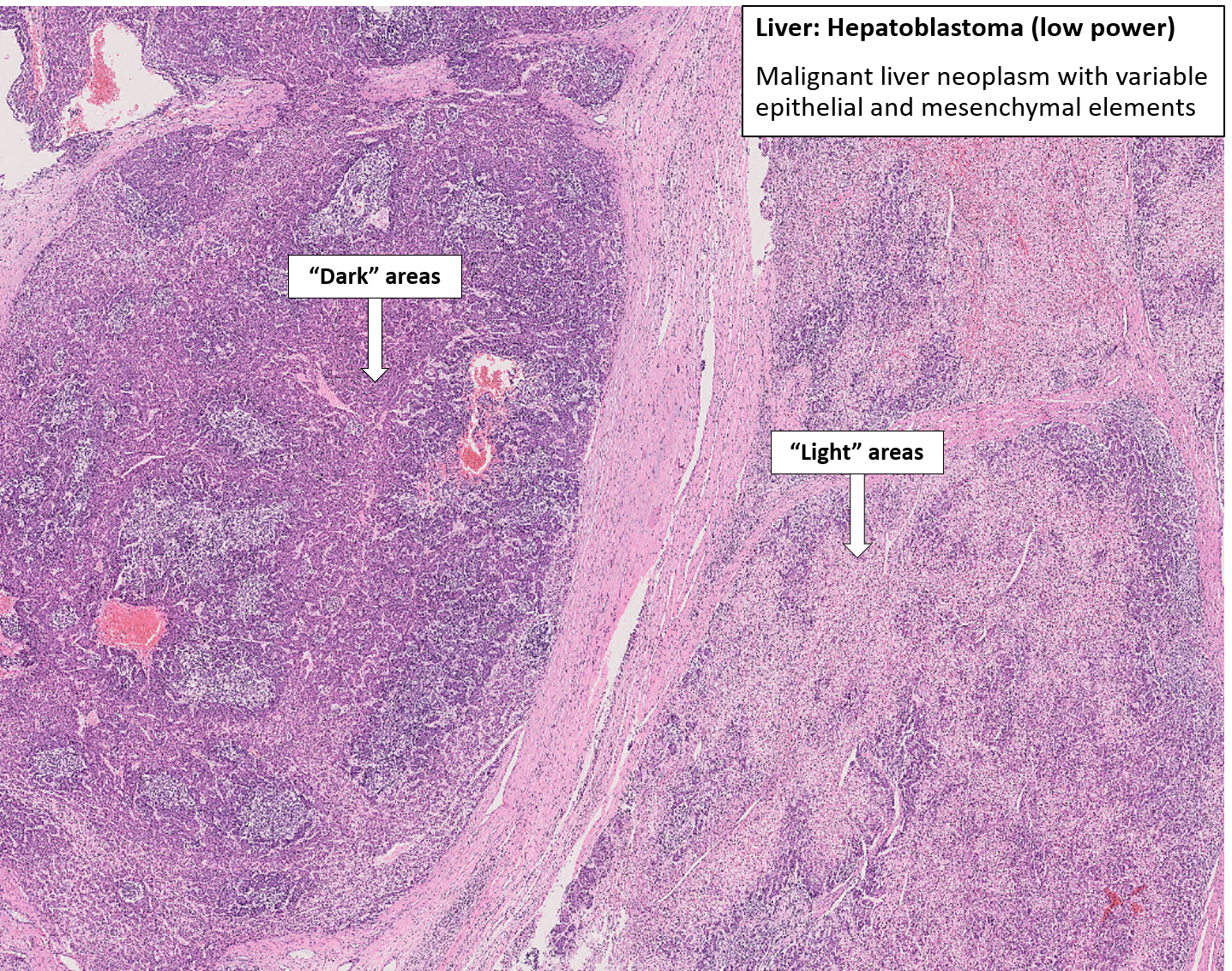 Liver – Hepatoblastoma – NUS Pathweb :: NUS Pathweb