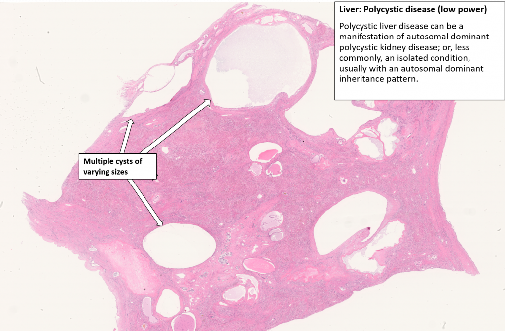 Liver – Polycystic Disease – NUS Pathweb :: NUS Pathweb