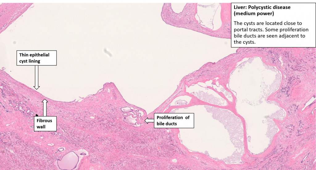 Liver – Polycystic Disease – NUS Pathweb :: NUS Pathweb