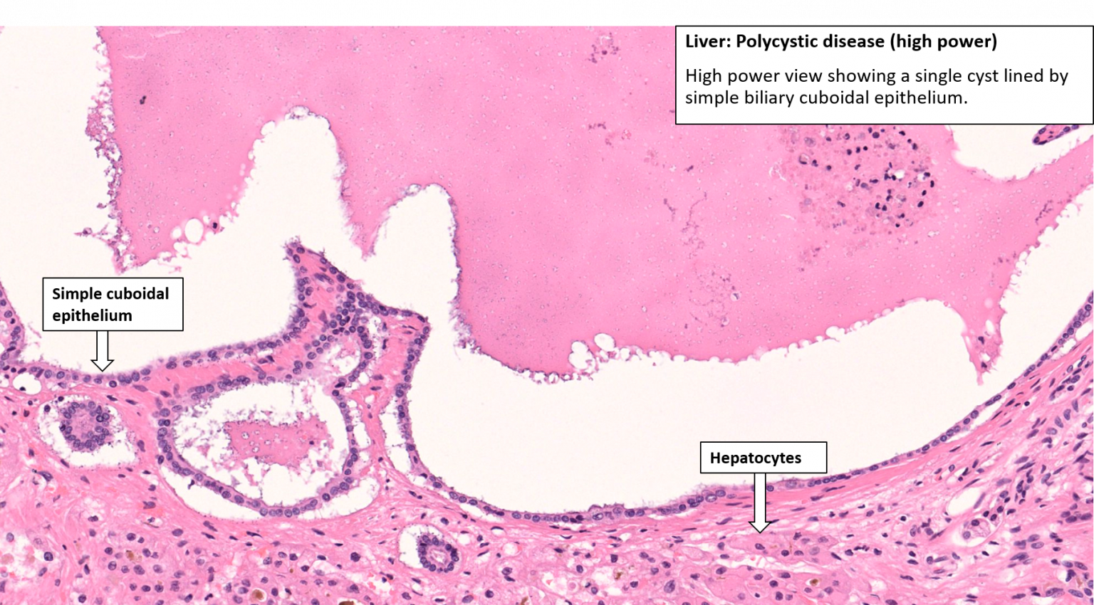 Liver – Polycystic Disease – NUS Pathweb :: NUS Pathweb