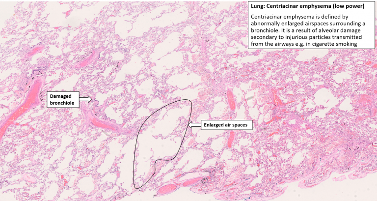 Lung – Emphysema – NUS Pathweb :: NUS Pathweb