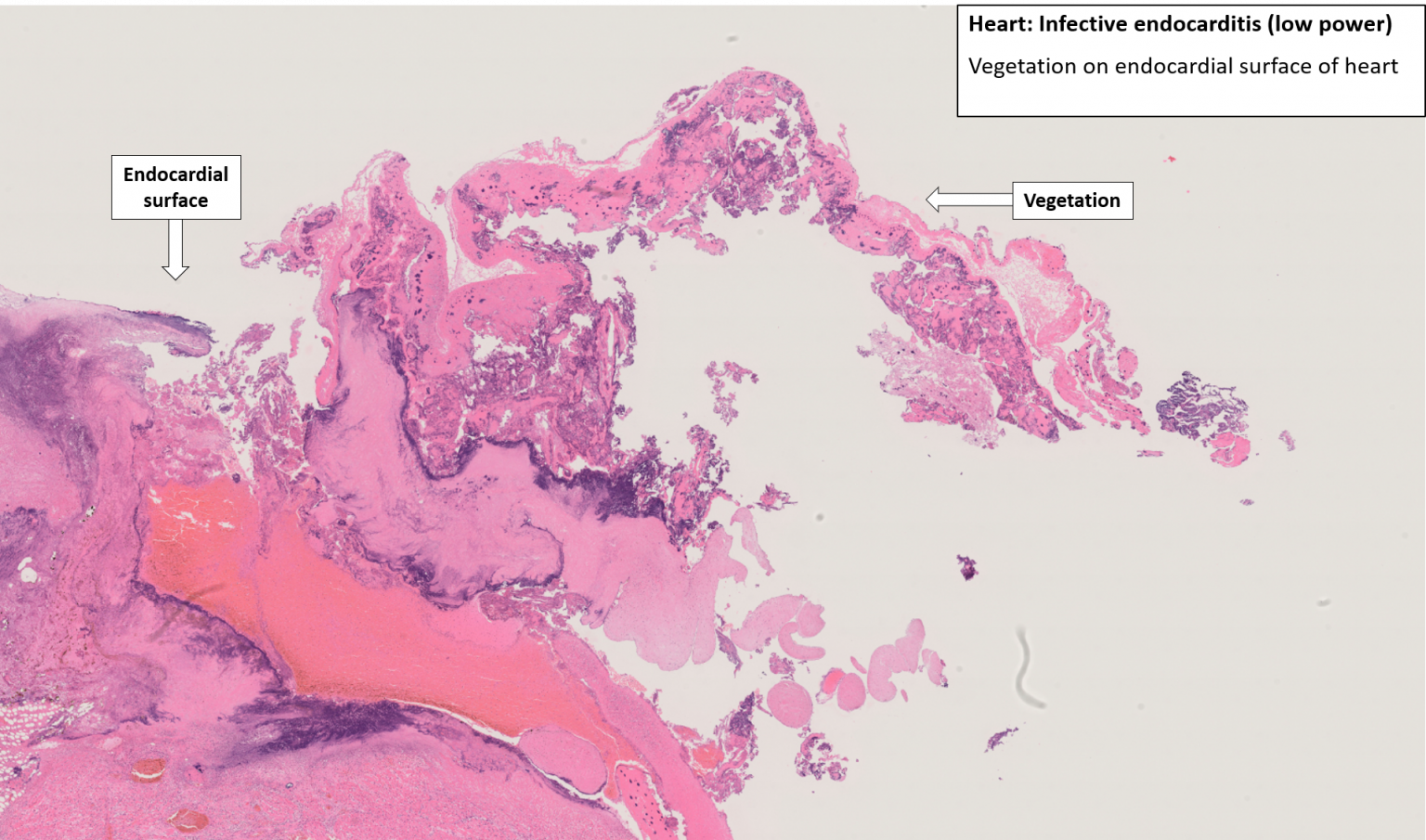 Heart – Infective Endocarditis – NUS Pathweb :: NUS Pathweb