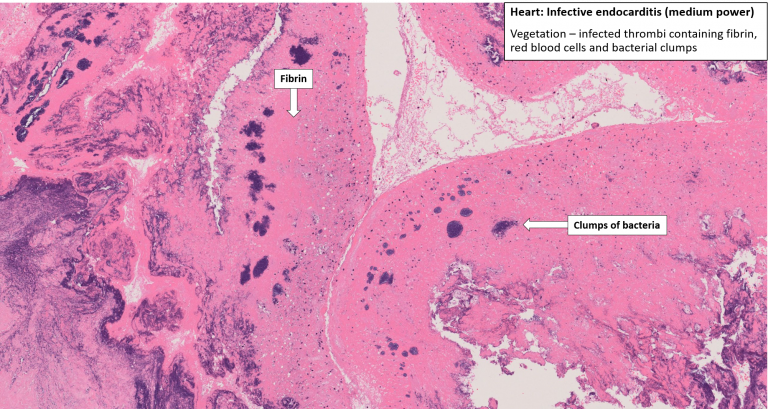 Heart – Infective Endocarditis – NUS Pathweb :: NUS Pathweb