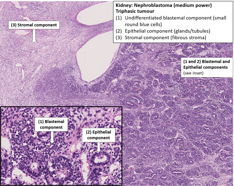 Kidney – Nephroblastoma – NUS Pathweb :: NUS Pathweb
