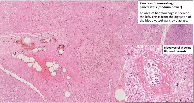 Pancreas – Acute Haemorrhagic Pancreatitis – NUS Pathweb :: NUS Pathweb