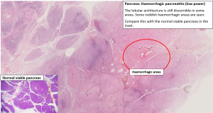 Pancreas – Acute Haemorrhagic Pancreatitis – NUS Pathweb :: NUS Pathweb
