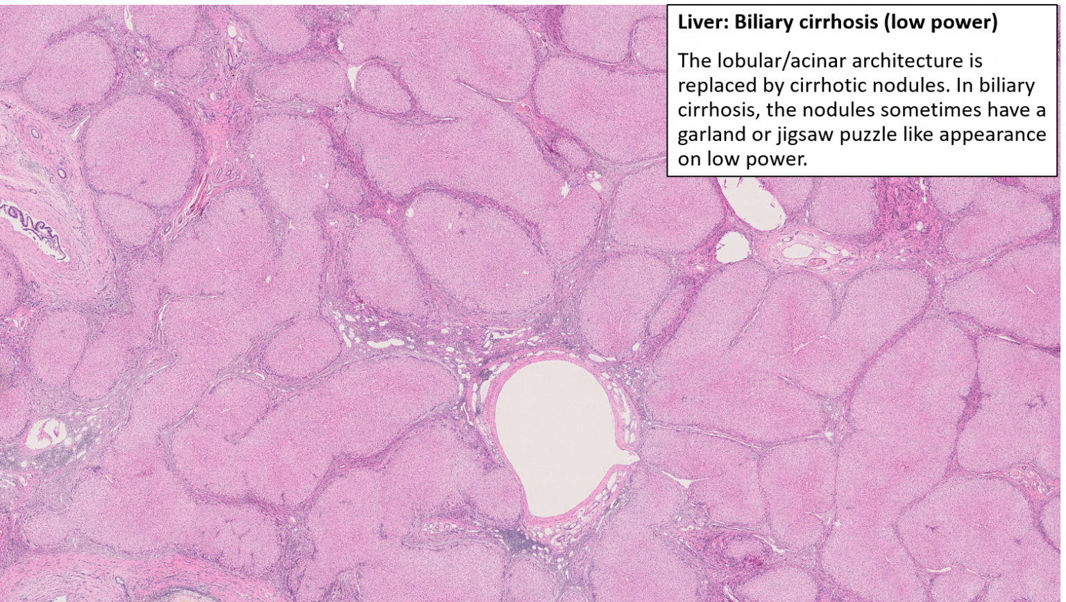 Liver Cirrhosis Nus Pathweb Nus Pathweb