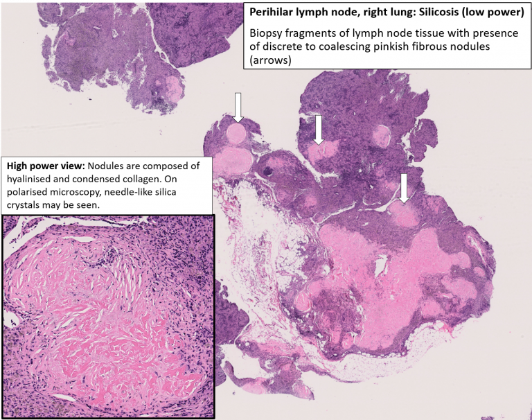 Lung – Silicosis – NUS Pathweb :: NUS Pathweb