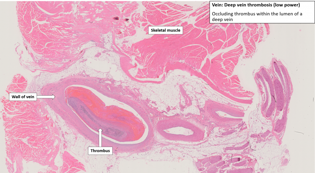 Vein – Occluding Thrombus – NUS Pathweb :: NUS Pathweb