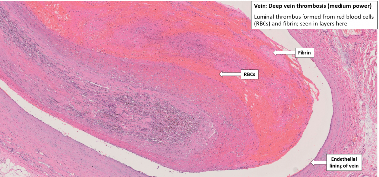 Vein – Occluding Thrombus – NUS Pathweb :: NUS Pathweb