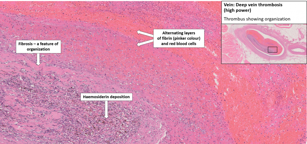 Vein – Occluding Thrombus – NUS Pathweb :: NUS Pathweb