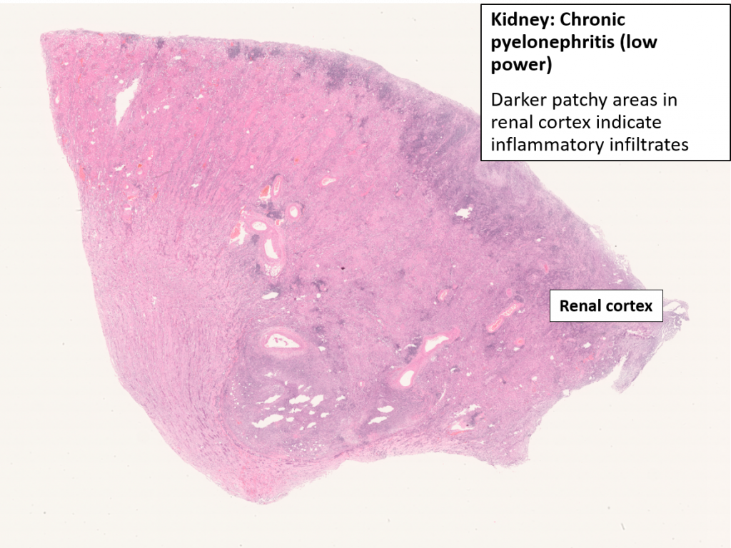 Kidney – Chronic Pyelonephritis – NUS Pathweb :: NUS Pathweb