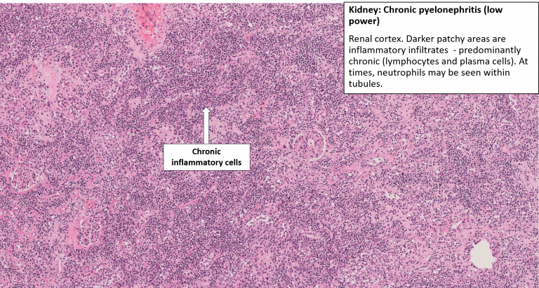Kidney – Chronic Pyelonephritis – NUS Pathweb :: NUS Pathweb