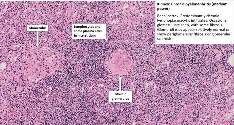 Kidney – Chronic Pyelonephritis – NUS Pathweb :: NUS Pathweb