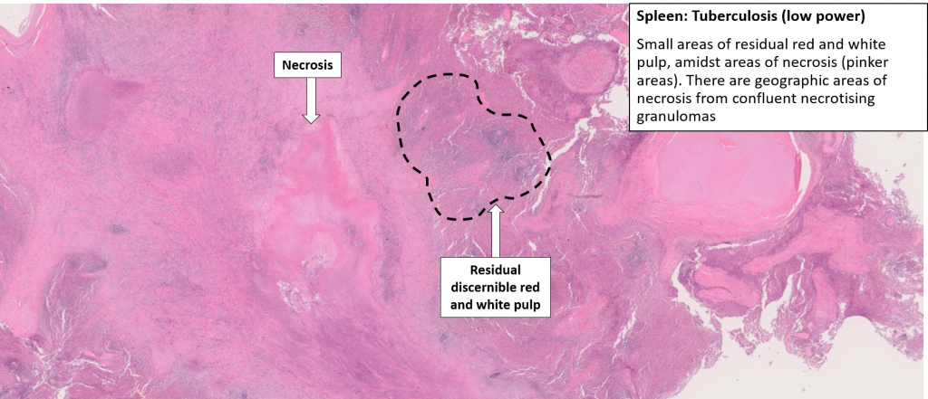 Spleen – Tuberculosis – NUS Pathweb :: NUS Pathweb