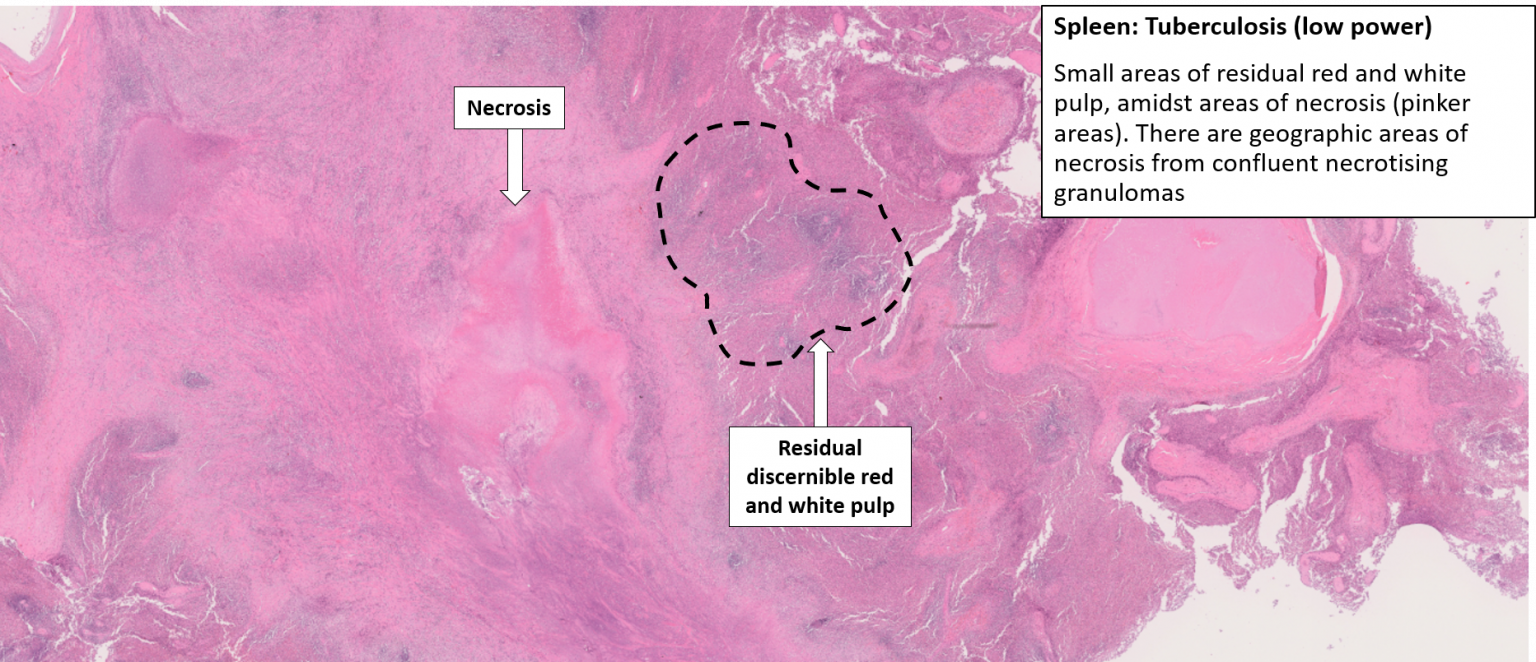 Spleen – Tuberculosis – NUS Pathweb :: NUS Pathweb