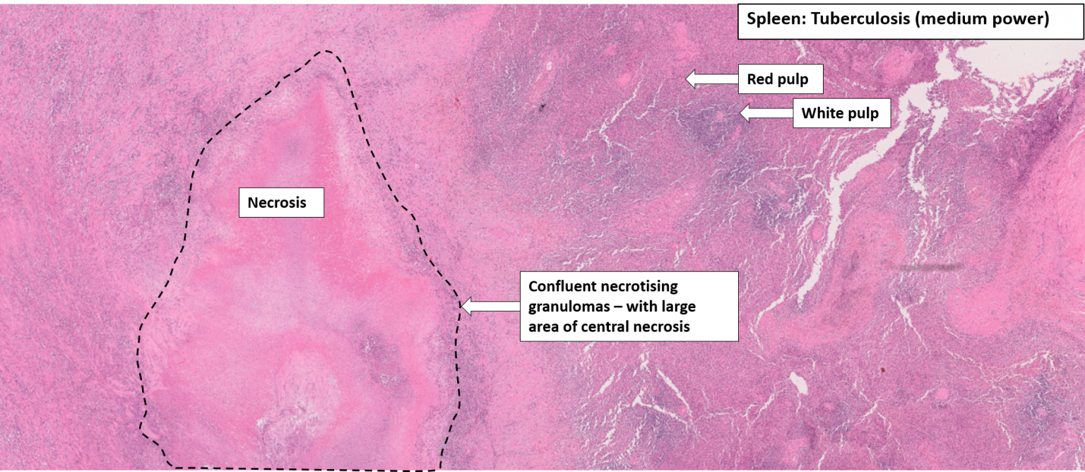 Spleen – Tuberculosis – NUS Pathweb :: NUS Pathweb