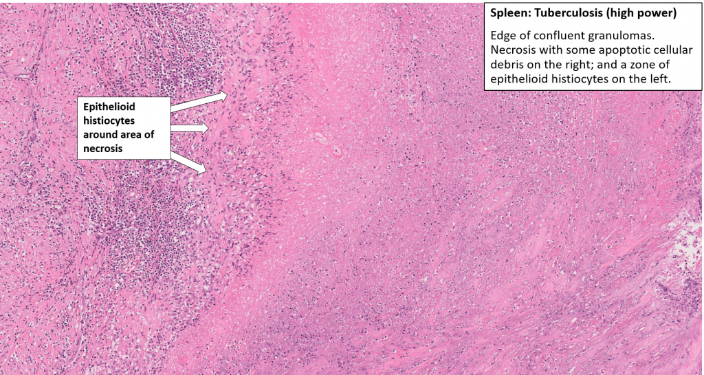 Spleen – Tuberculosis – NUS Pathweb :: NUS Pathweb