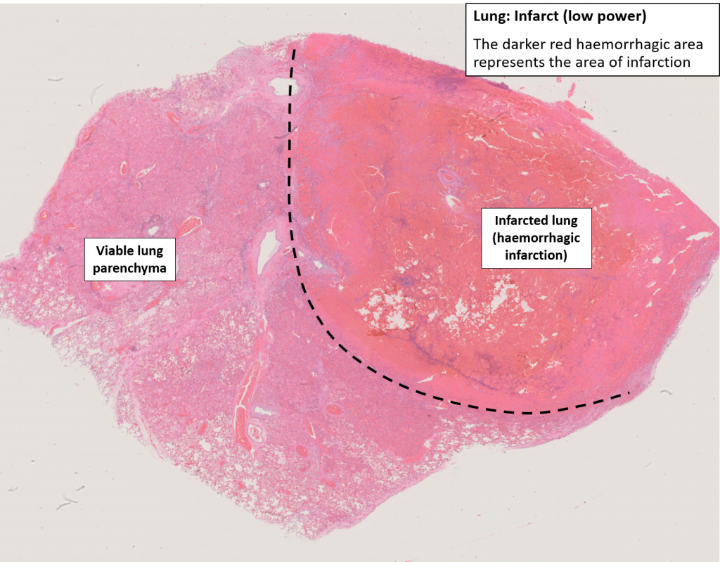 Heart with Lungs – Thromboembolism – NUS Pathweb :: NUS Pathweb