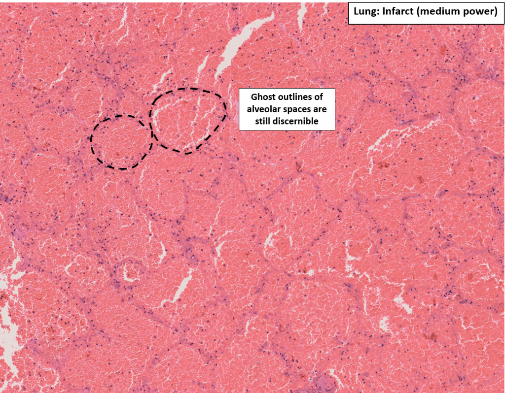 Heart with Lungs – Thromboembolism – NUS Pathweb :: NUS Pathweb