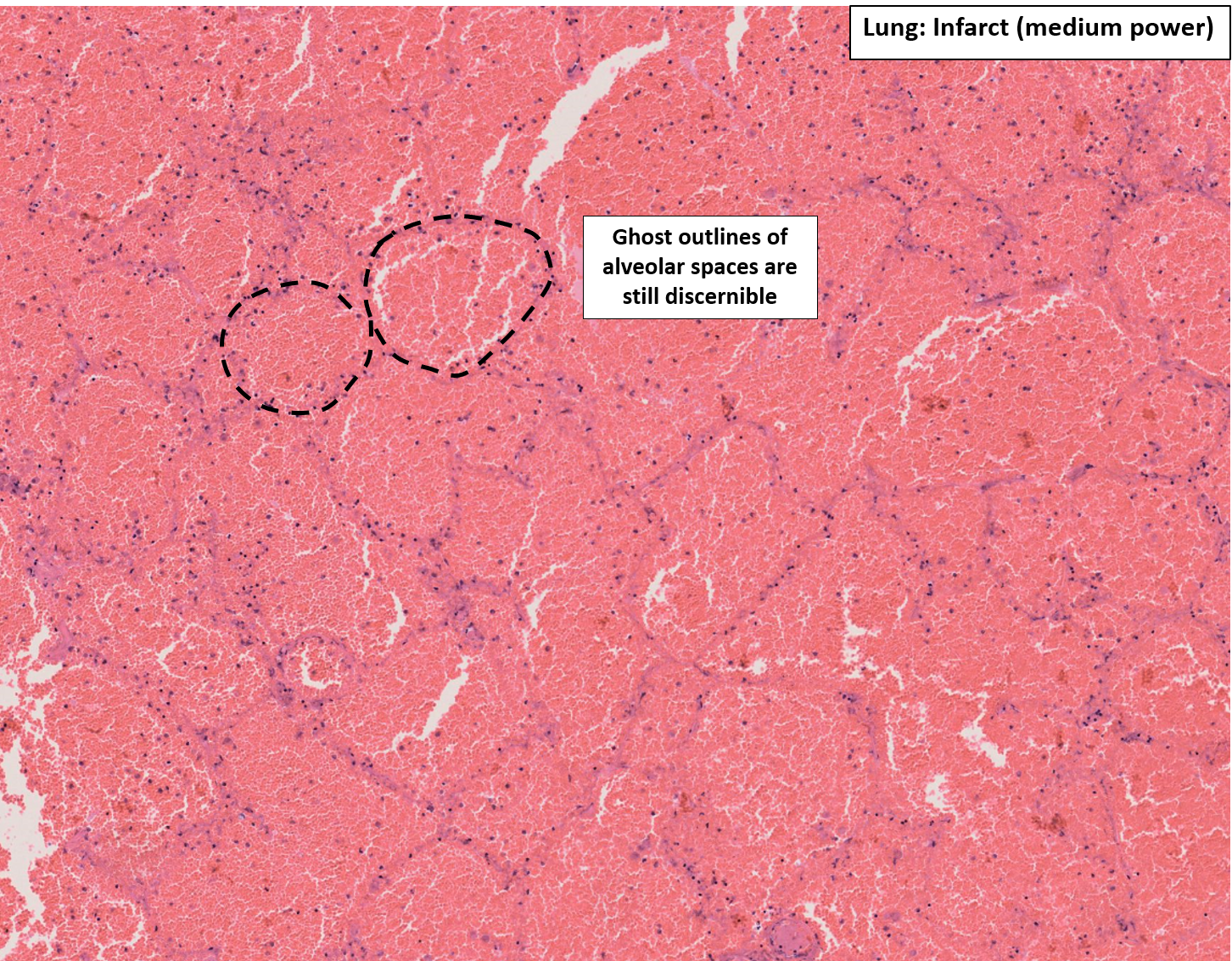 Heart with Lungs – Thromboembolism – NUS Pathweb :: NUS Pathweb