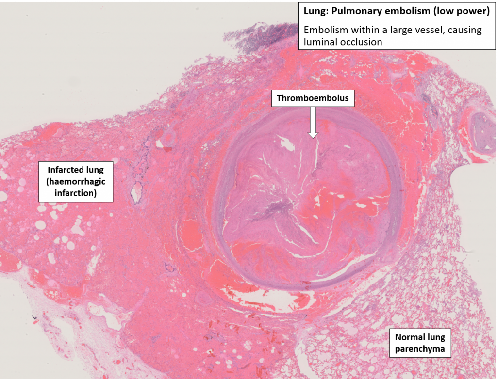 Heart with Lungs – Thromboembolism – NUS Pathweb :: NUS Pathweb