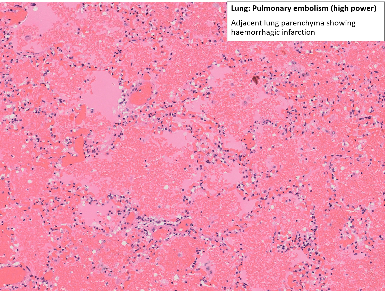 Heart with Lungs – Thromboembolism – NUS Pathweb :: NUS Pathweb