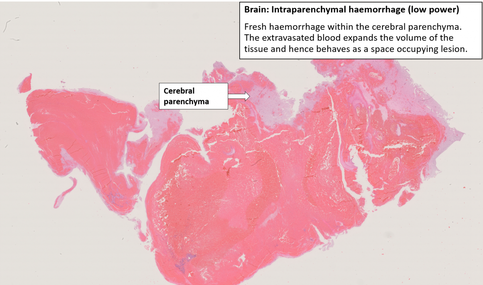 Brain – Haemorrhage – NUS Pathweb :: NUS Pathweb