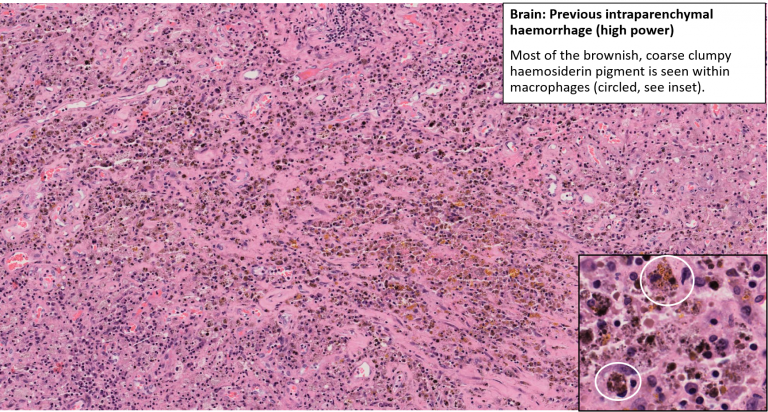 Brain – Haemorrhage – NUS Pathweb :: NUS Pathweb