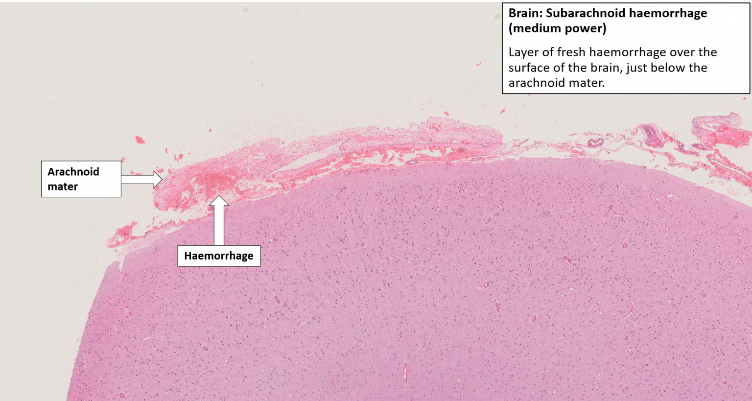 Brain – Subarachnoid Haemorrhage – NUS Pathweb :: NUS Pathweb