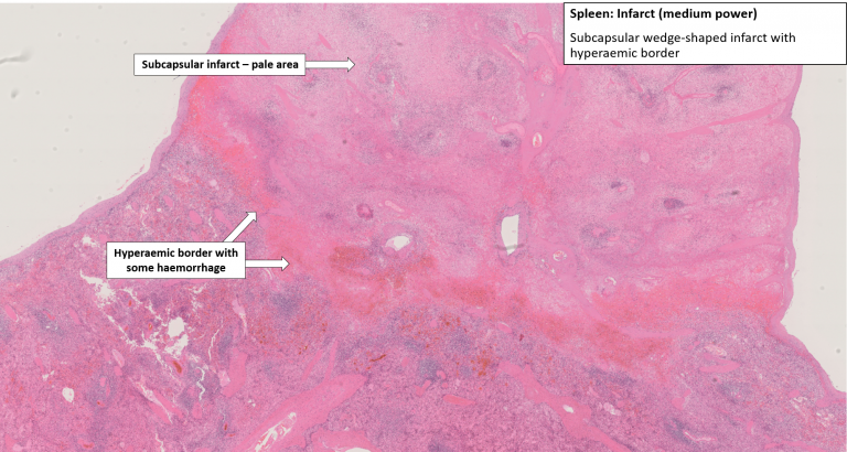Spleen – Infarct – NUS Pathweb :: NUS Pathweb